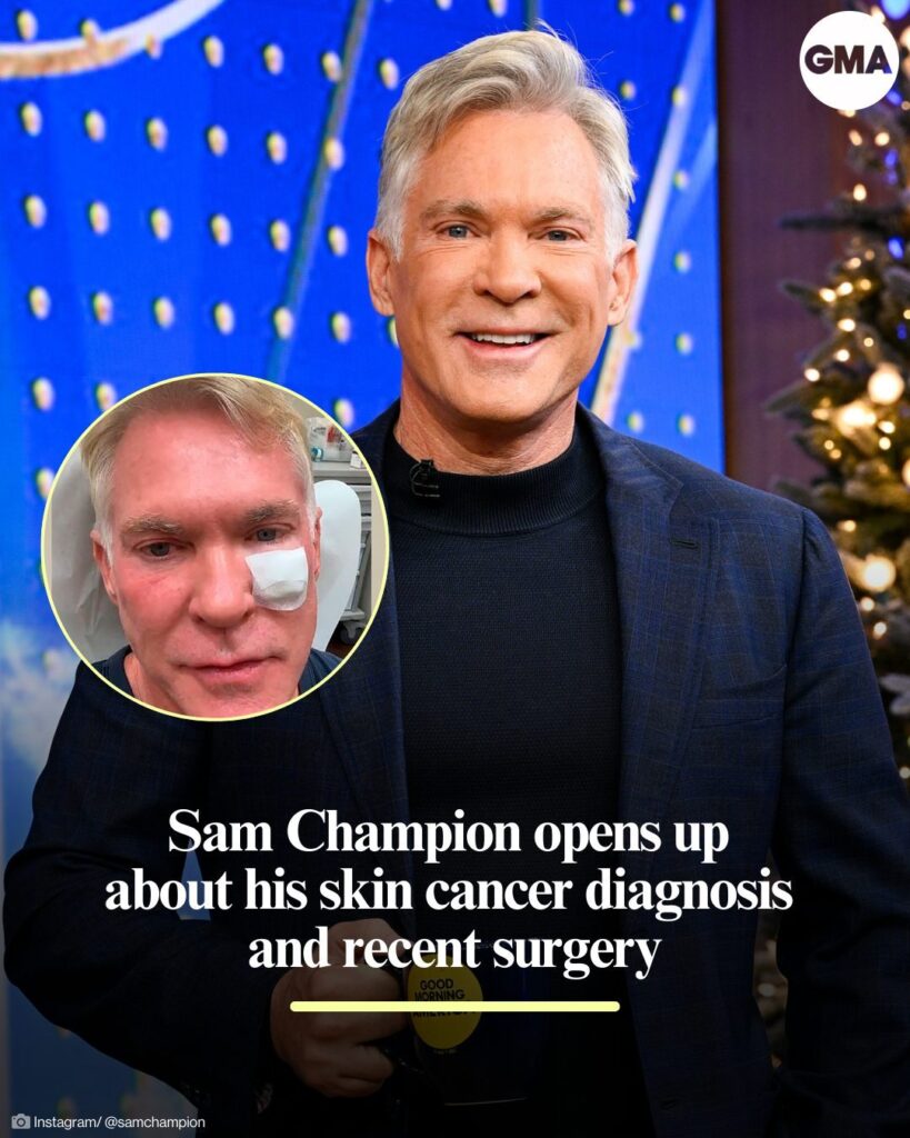 Sam Champion’s Skin Cancer Journey: A Wake-Up Call for Regular Skin Exams
