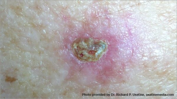 Basal Cell Carcinoma Warning Signs and Images