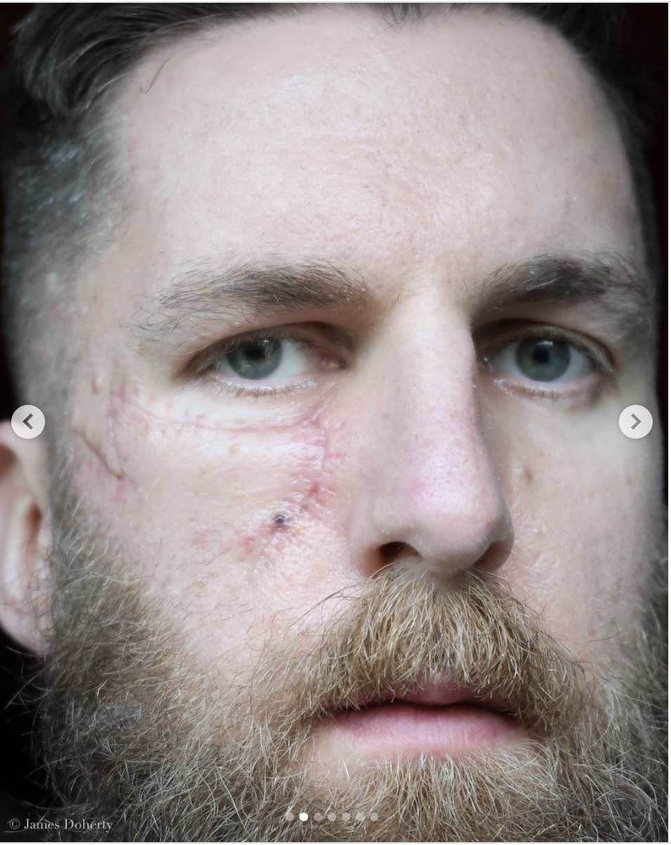 “This Is Skin Cancer” Stories