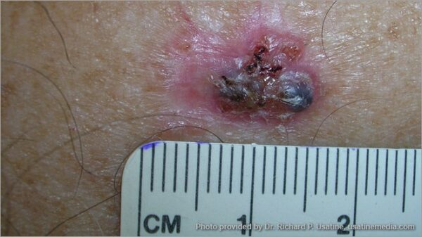 Basal Cell Carcinoma Warning Signs and Images