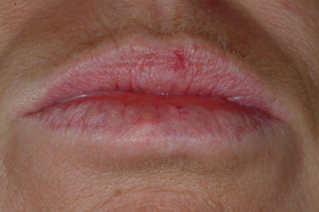 Ask the Expert: What Will Help Me Feel Less Nervous About My Lip Cancer?