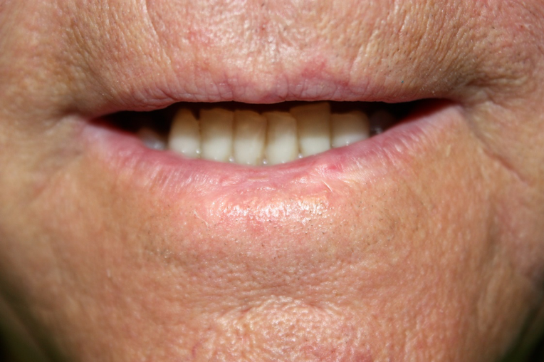 Lips Cancer Symptoms In Hindi At Azzie Molina Blog
