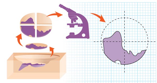 Squamous Cell Carcinoma Treatment