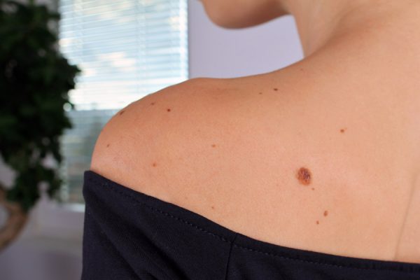 Ask the Expert: Is It Normal to Get New Moles in Your 30s?