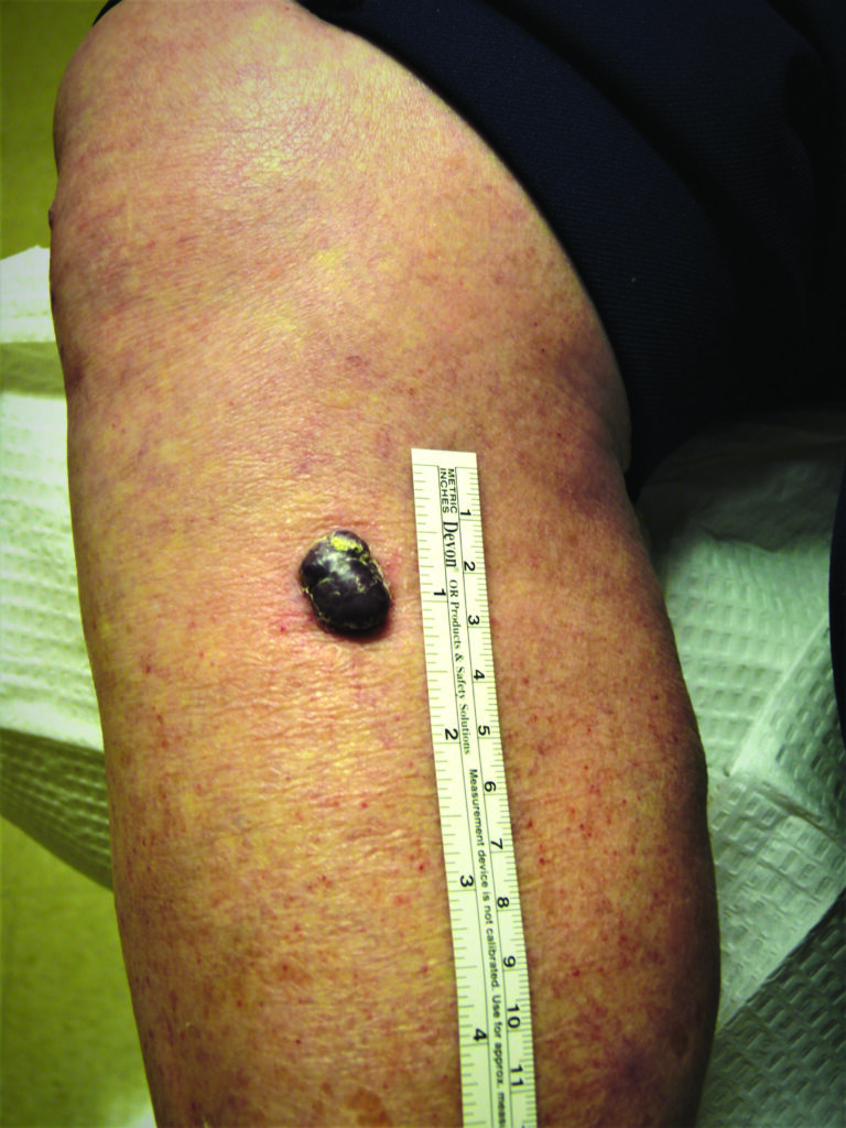 Skin Cancer in Skin of Color