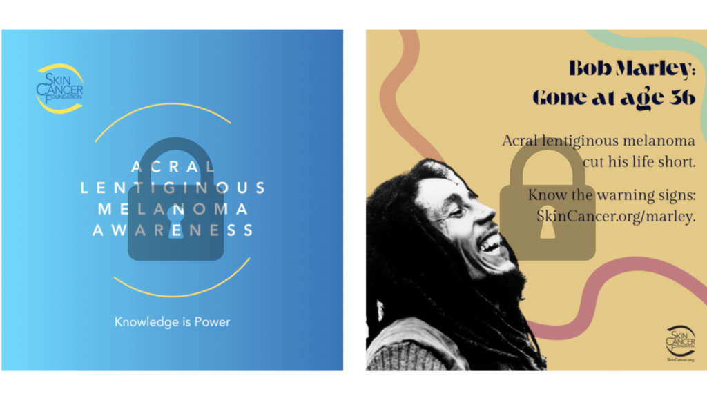 Bob Marley non sarebbe dovuto morire di melanoma