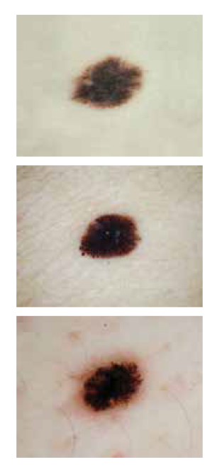 Ask the Expert: Why Have Your “ABCDEs” for the Warning Signs of ...